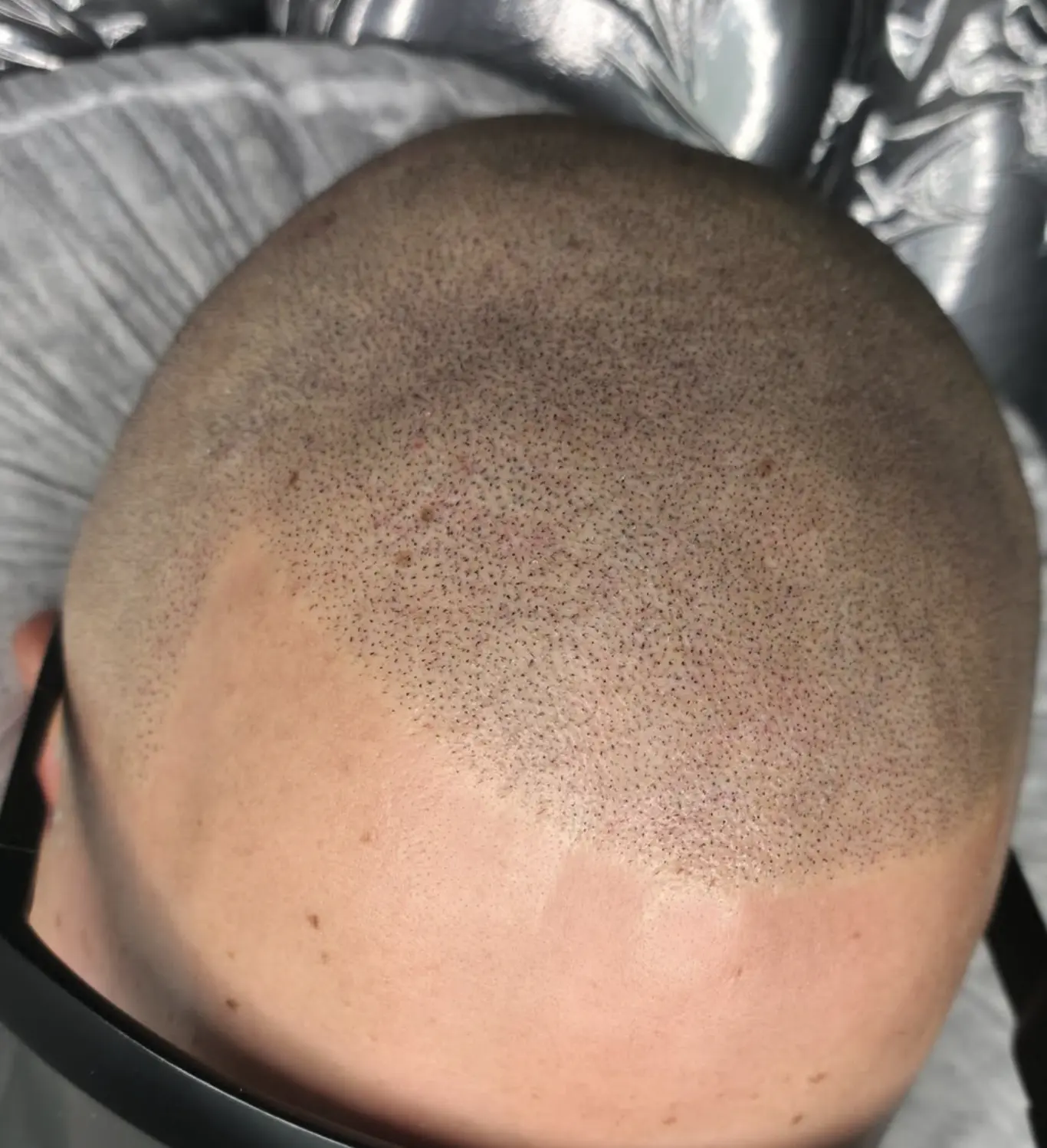 Why Are You Losing Hair? Common Causes And What To Do First